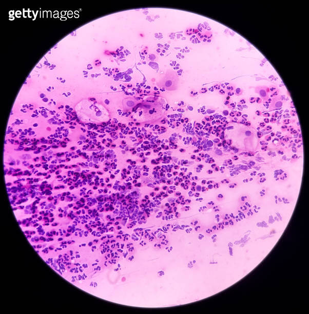 Conventional pap's smear: Reactive cellular changes associated with ...