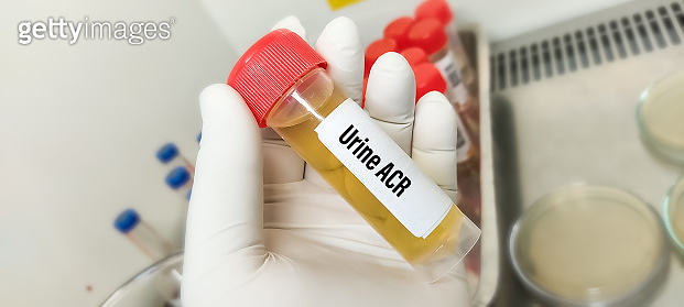 Urine Sample for Urine ACR (Albumin creatinine Ratio). Diagnosis of ...