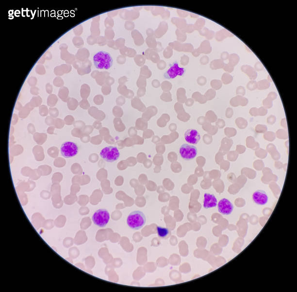 Microscopic image showing thrombocytopenia with leukocytosis, monocytes ...