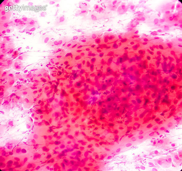 Vault smear: Reactive cellular changes with inflammation, photo under ...