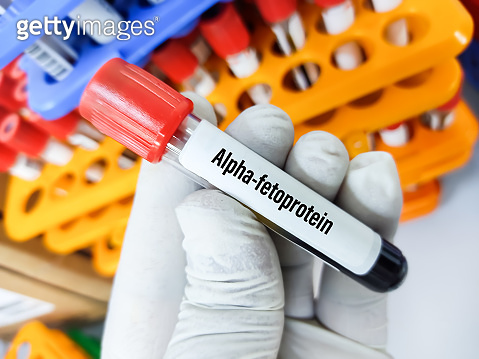Technologist hand holding a blood sample for Alpha fetoprotein(AFP ...
