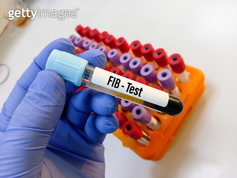 Blood sample for FIB(Fibrinogen) test. Close view. Deep venous ...