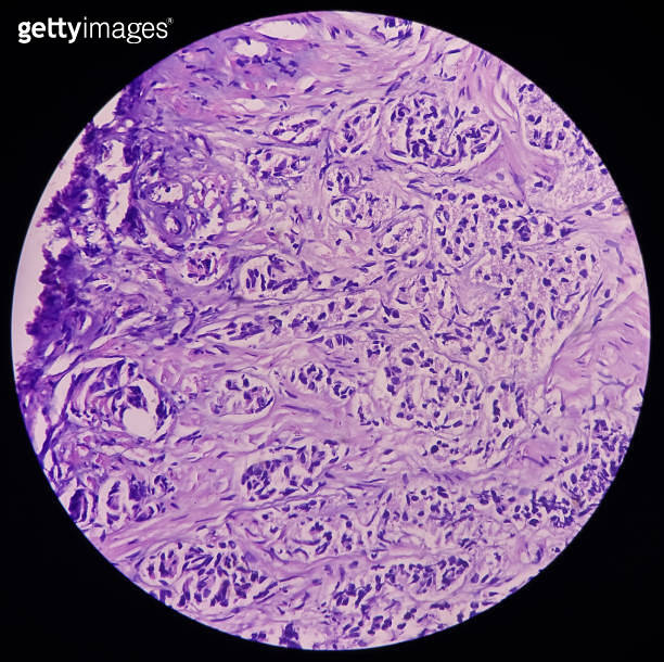 Prostatic chips: Microphotograph show focal area of adenocarcinoma ...