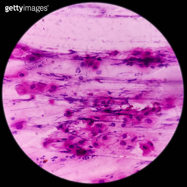 Vault smear: Reactive cellular changes with inflammation, photo under ...