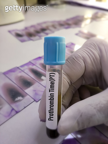 Blood Sample for Prothrombin time (PT) Test. Blood coagulation testing ...