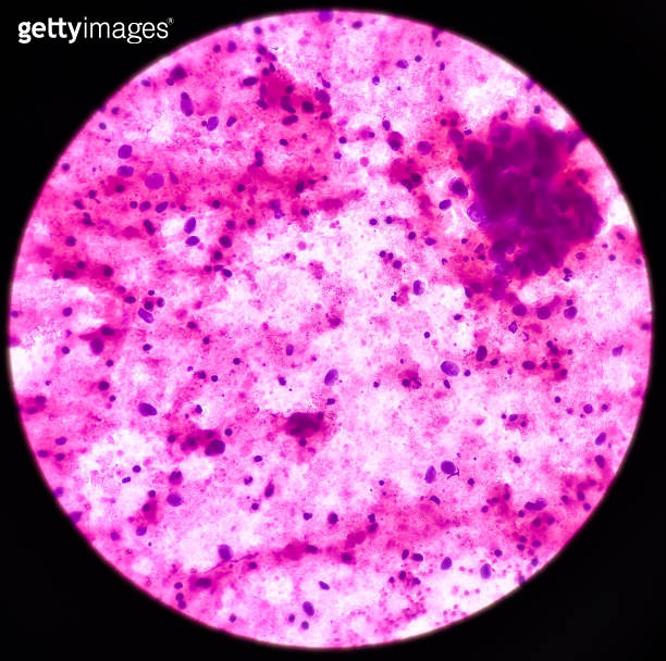 Breast lump malignant cell ductal carcinoma, FNAC slide microscopic ...