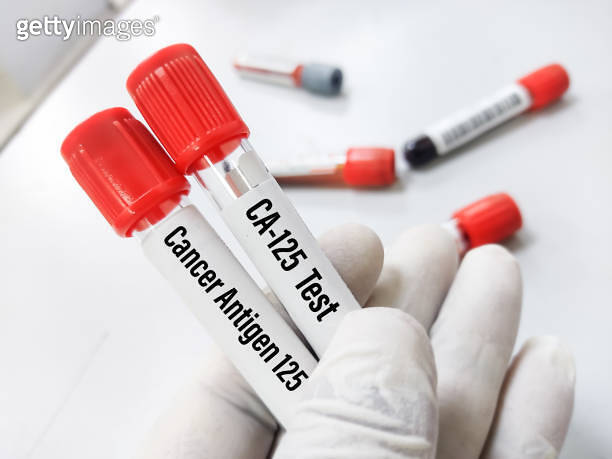 Blood sample for CA 125 test, diagnosis of overian cancer (1342399337 ...
