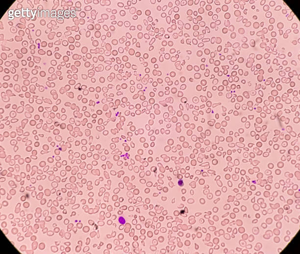 Hereditary hemolytic anemia. Hemoglobin E (HbE) disease, hypochromia ...