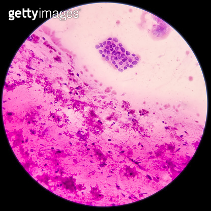High grade squamous intraepithelial lesion(HSIL). Photomicrograph of ...