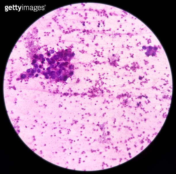 Breast lump malignant cell ductal carcinoma, FNAC slide microscopic ...
