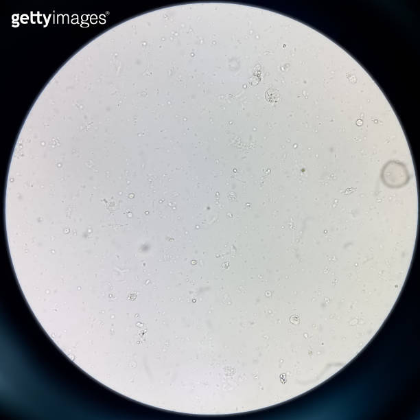 Semen analysis, sperm analysis on microscopic examination ...