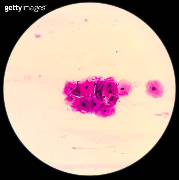 Microscopic image of Cervical smear (paps) cytology, reactive cellular ...