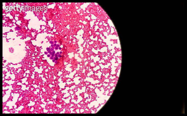 Breast lump malignant cell ductal carcinoma, FNAC slide microscopic ...