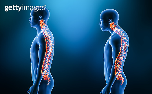 Comparison between normal curvature of the spine and kyphosis with male ...