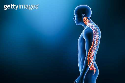 Kyphosis pathology with man model from lateral view 3D rendering ...