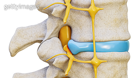 Herniated disc with spinal nerve compression 3D rendering illustration ...