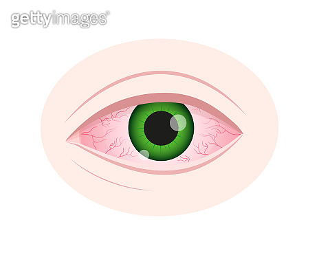 Eye irritation. Inflamed bloodshot eyeball with red conjunctiva ...