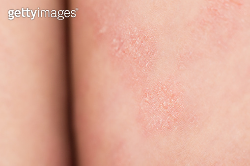 Close-up severe atopic eczema on the legs behind the knees of a child ...