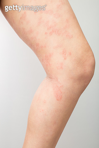 Acute atopic dermatitis on the legs of a child is a dermatological ...