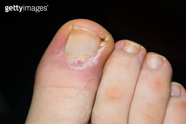 close-up photo of a toenail infection in human 이미지 (1308461204) - 게티이미지뱅크