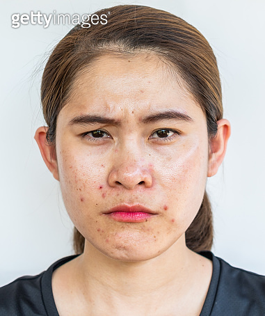 Unhappy Asian woman having problems of oily skin and acne inflamed on ...