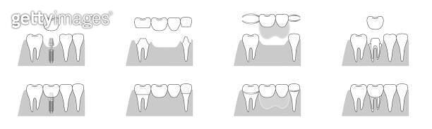 Implant bridge removable partial denture comparison illustration 이미지 ...