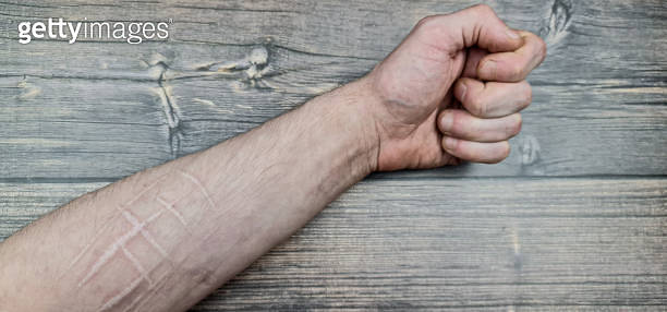 Scars on the arm. Cut marks on the arm. Hand injuries. Scars on the ...