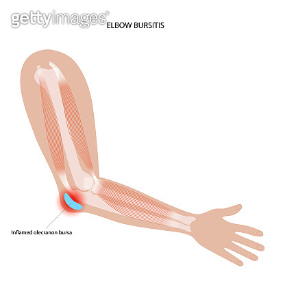 Student elbow bursitis 이미지 (1328586841) - 게티이미지뱅크