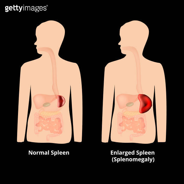 Splenomegaly of the spleen. Enlargement of the spleen. Vector ...