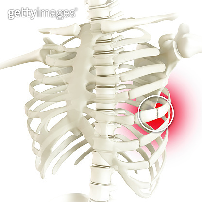 Anatomy and the human body. Costochondral separation, separated rib ...