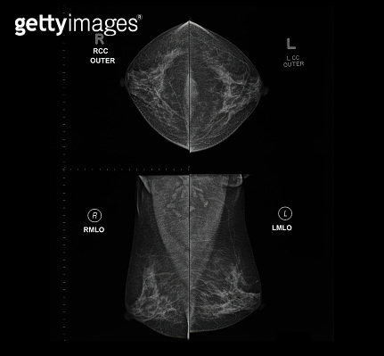 X-ray Digital Mammogram or mammography both side of the breast CC View ...