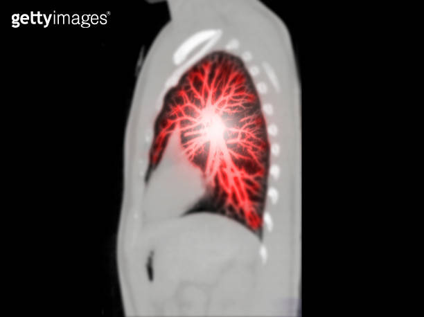 CT Chest Sagittal MIP view for diagnostic lung cancer , tuberculosis ...