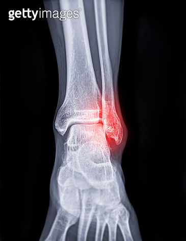 X-ray image of ankle joint showing fracture fibula of ankle joint. 이미지 ...