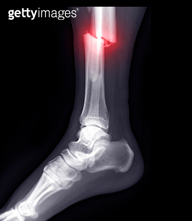 X-ray image of ankle joint showing fracture tibia and fibula bone.' 이미지 ...