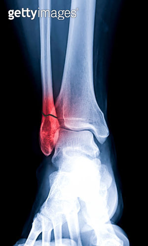 X-ray ankle or Radiographic image or x-ray image of right ankle joint ...