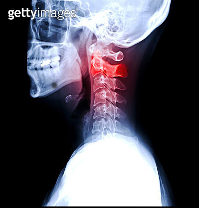 X-ray C-spine or x-ray image of Cervical spine lateral view for ...