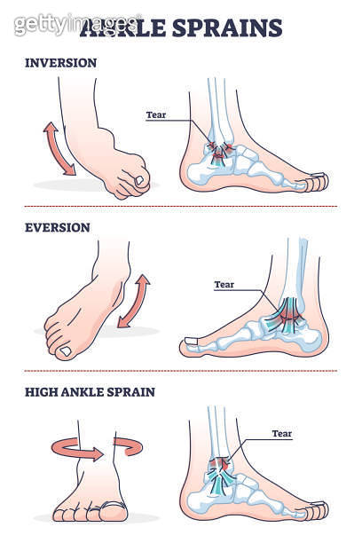 Ankle sprains situations with inversion and eversion injury outline ...