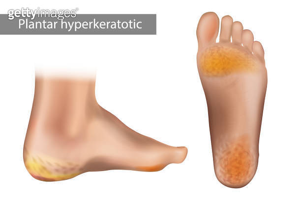 Palmoplantar hyperkeratosis. Keratoderma. Vector illustration of ...
