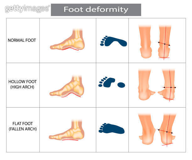 Foot deformation. Types pathologies of foot. Hollow, flat and normal ...