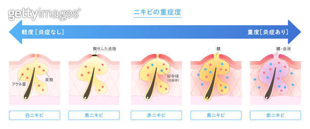 Illustration of acne type and severity shown in skin cross section ...