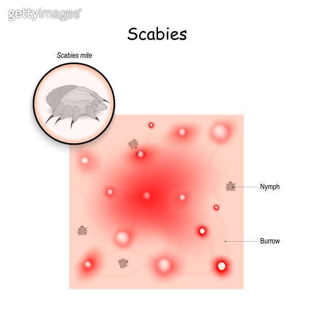 Scabies. contagious skin infestation. (1342263725) - 게티이미지뱅크