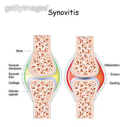 synovitis. healthy joint and a joint with inflammation of the synovial ...