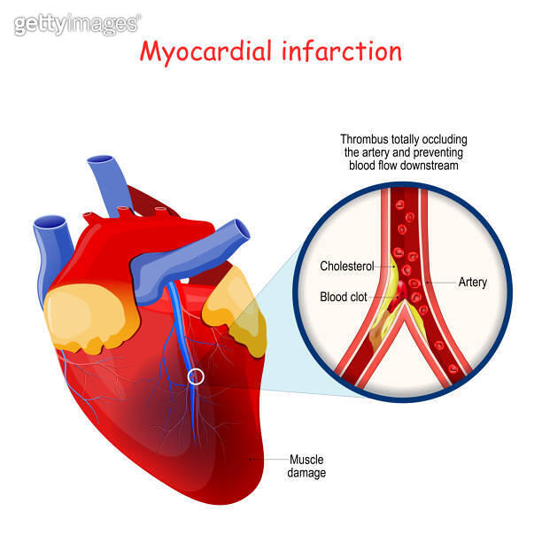 Myocardial infarction. heart attack. 이미지 (1308953277) - 게티이미지뱅크