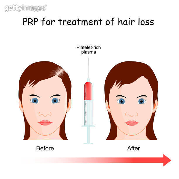 PRP procedure for treatment of hair loss. 이미지 (1304734986) - 게티이미지뱅크