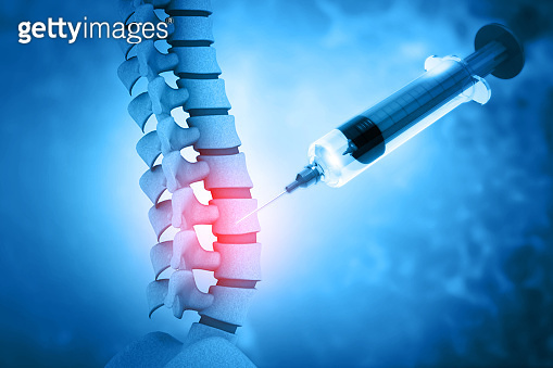 3d illustration of a lumbar spine injection 이미지 (1339647929) - 게티이미지뱅크