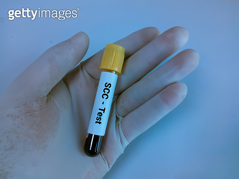 Blood sample for SCC (Squamous cell carcinoma) test, skin cancer 이미지 ...