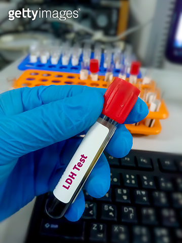 Blood sample tube for lactate dehydrogenase or LDH test, diagnosis for ...