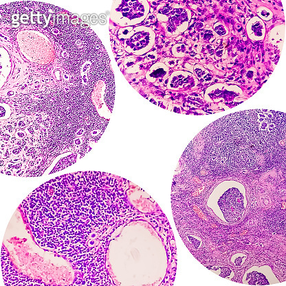 College of four photomicrograph showing Invasive ductal carcinoma (IDC ...