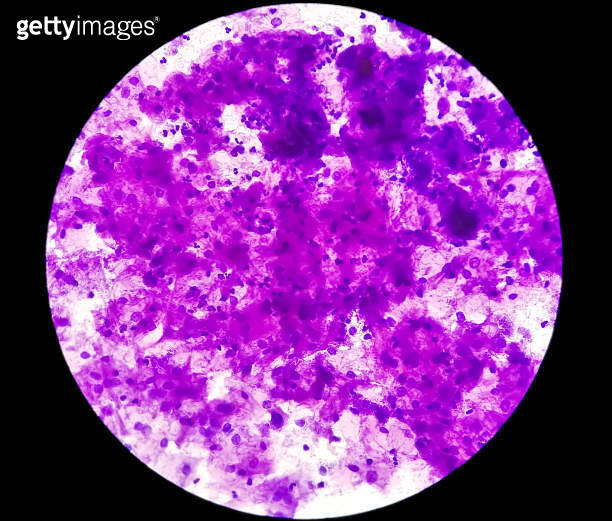 View in microscopic of human cervix cells. Squamous epithelial cells ...