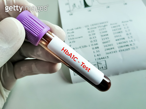 Blood sample for HbA1c (Hemoglobin A1c). Diabetic treatment monitoring ...